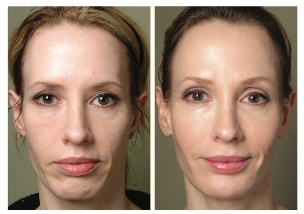 Voluma | Patel Plastic Surgery