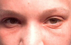 What are Dennie-Morgan lines and how do you treat them? | Patel Plastic ...