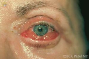 What is Chemosis? What are the causes of Chemosis? How do you treat ...